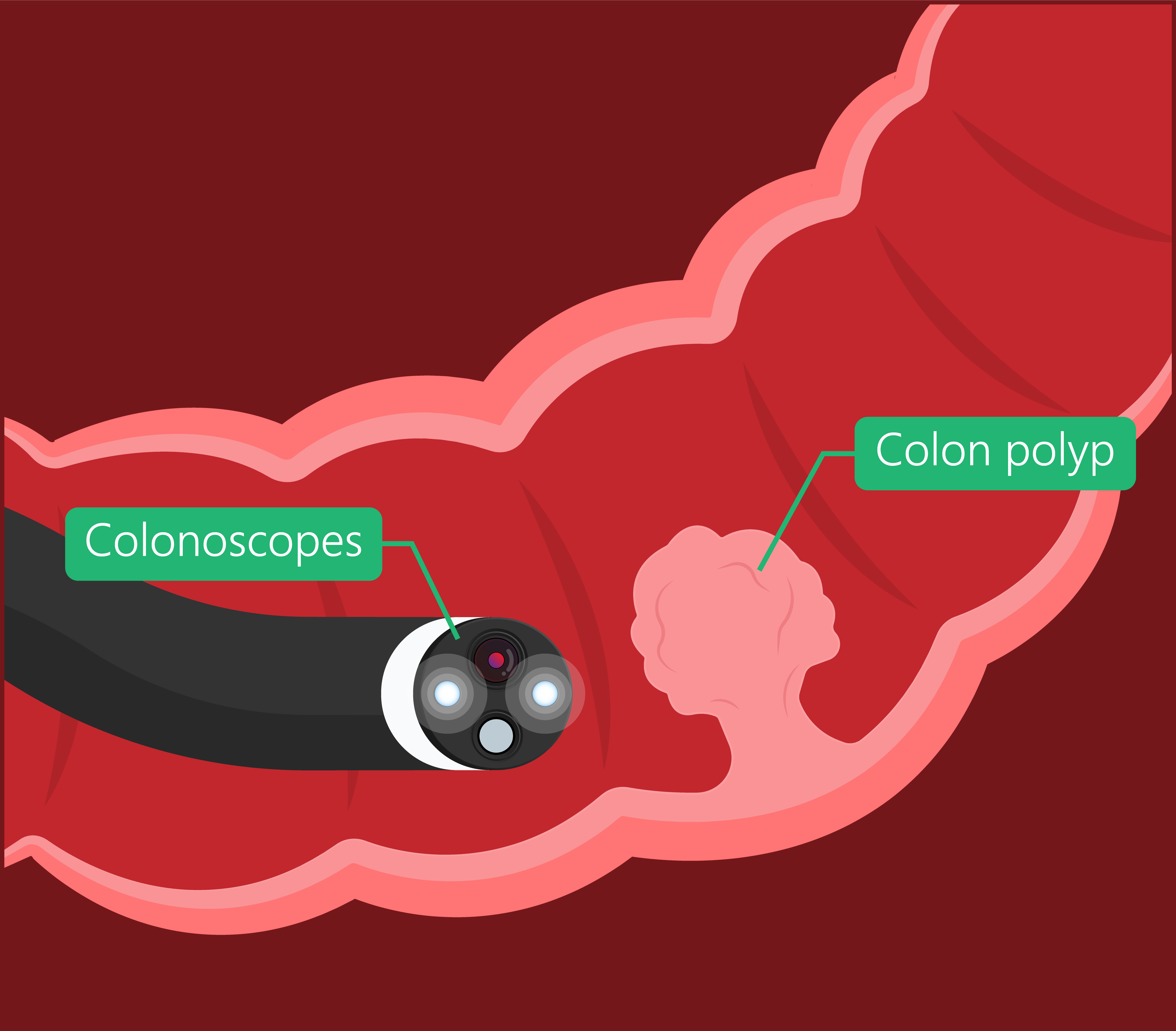 EMR + Polypectomy| Dubai Gastroenterology Clinic